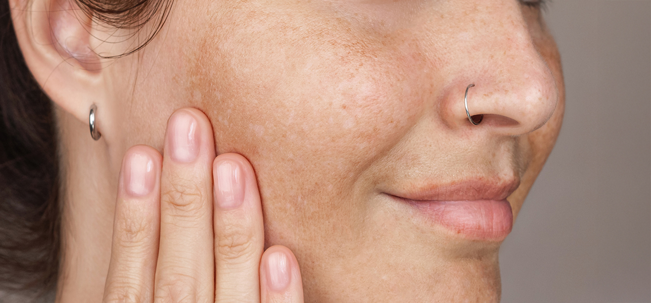 Macchie sulla pelle del viso: come riconoscerle e trattarle